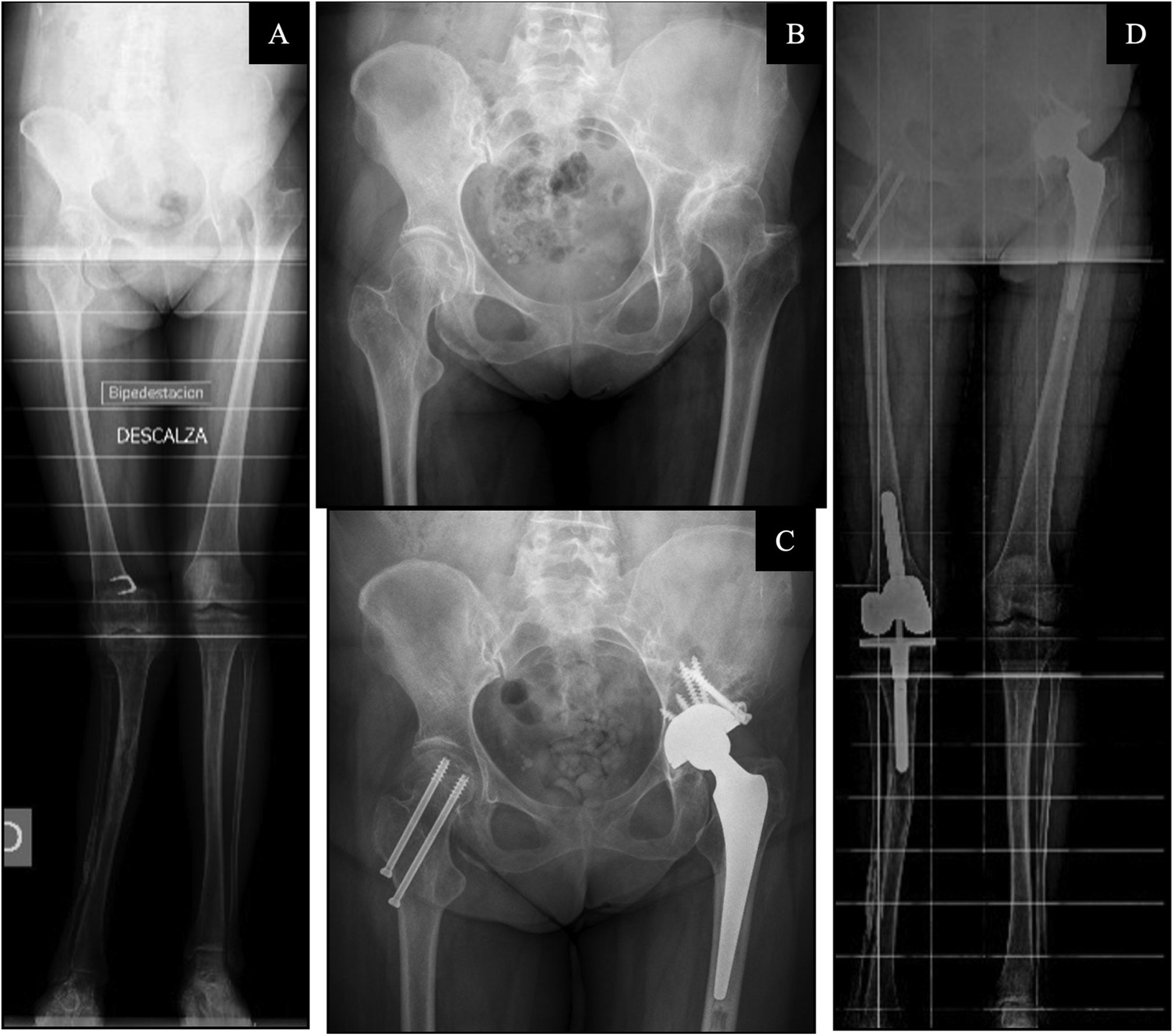 [Translated article] Primary total hip arthroplasty in patients with ...