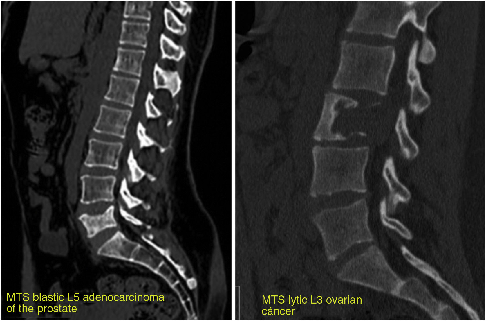 [Translated article] Epidemiology and clinic of vertebral metastasis ...