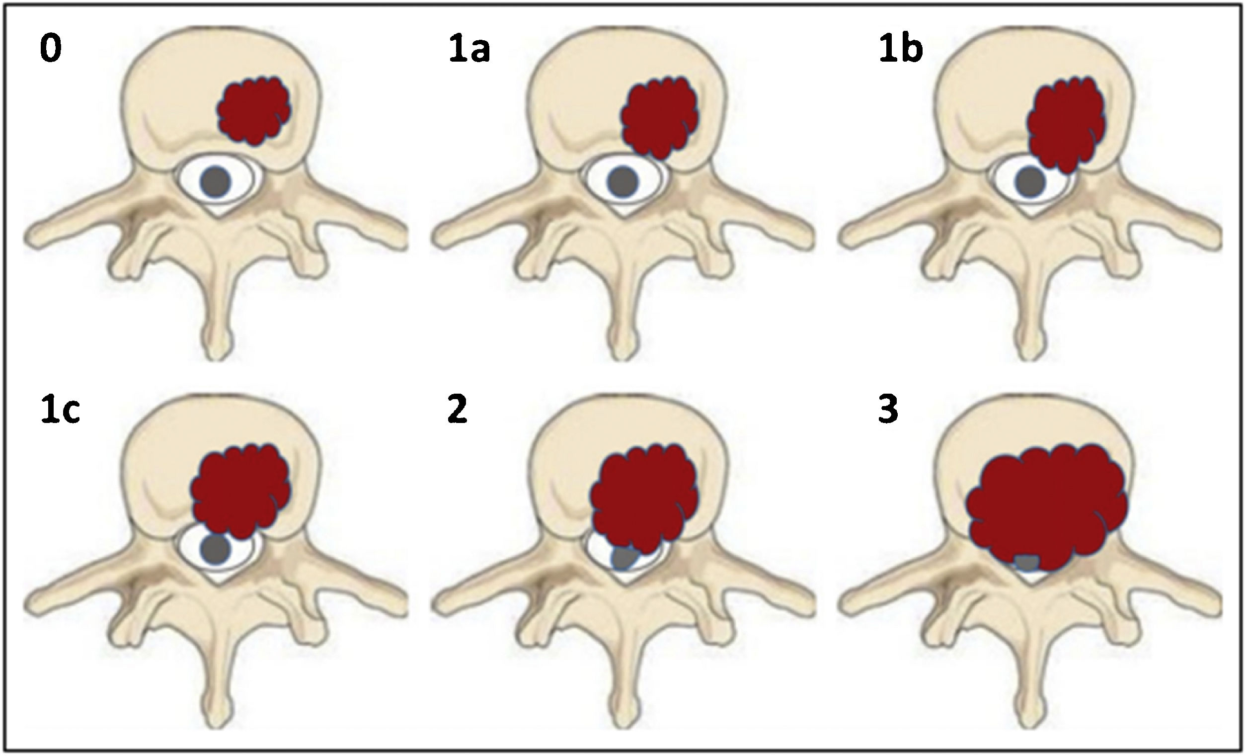 [Translated article] Role of radiotherapy in the management of spine ...