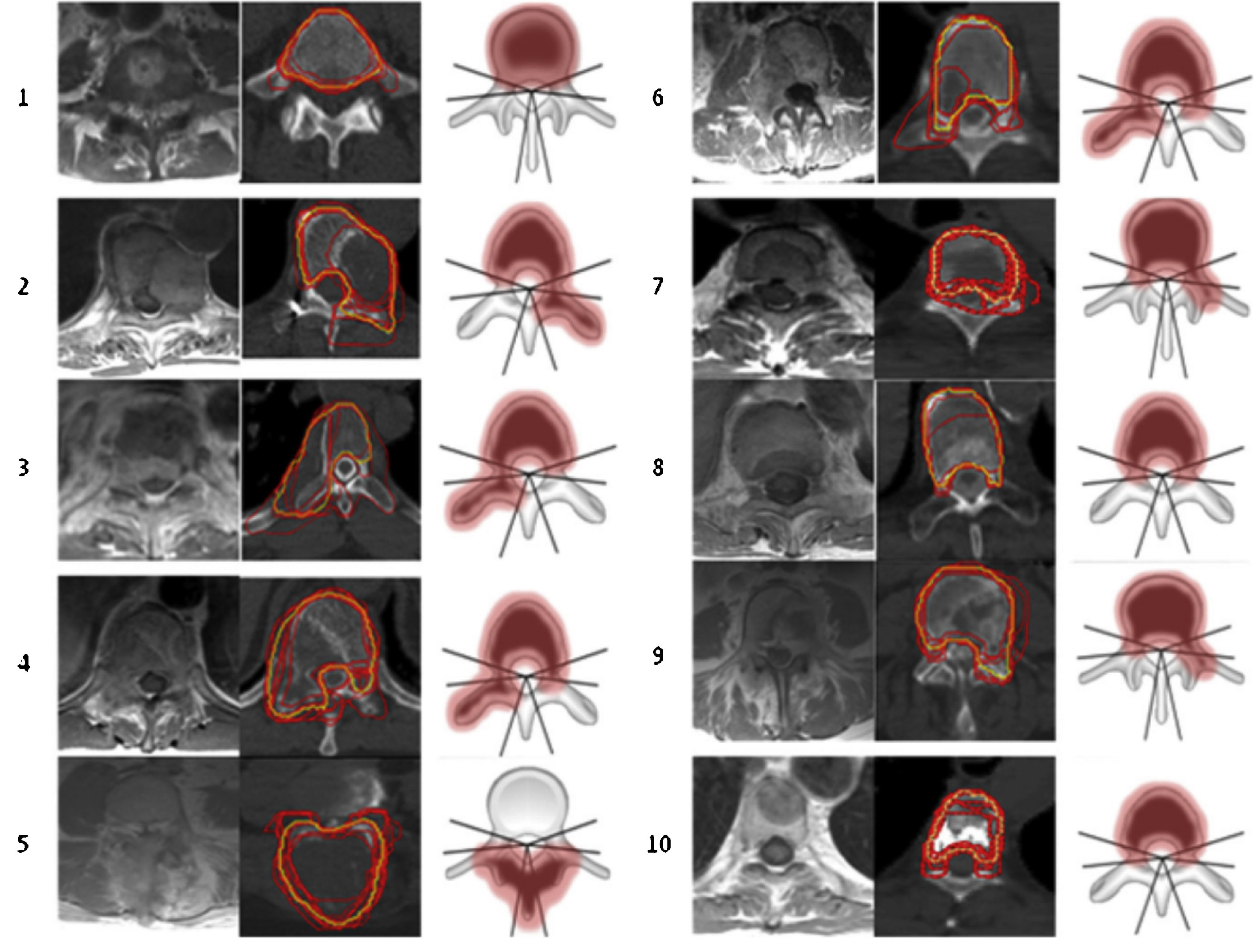 [Translated article] Role of radiotherapy in the management of spine ...