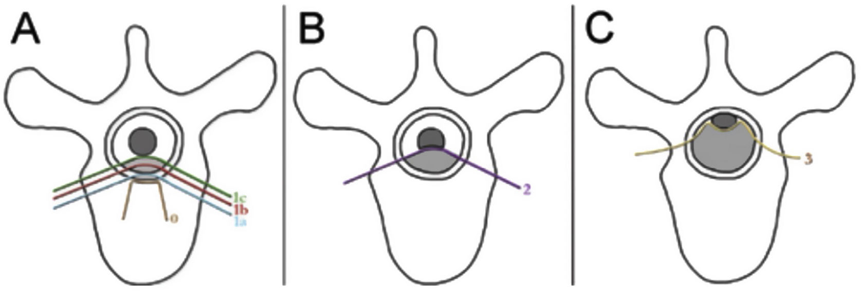 El enfoque de NOMS para los tumores metastásicos: integración de nuevas ...