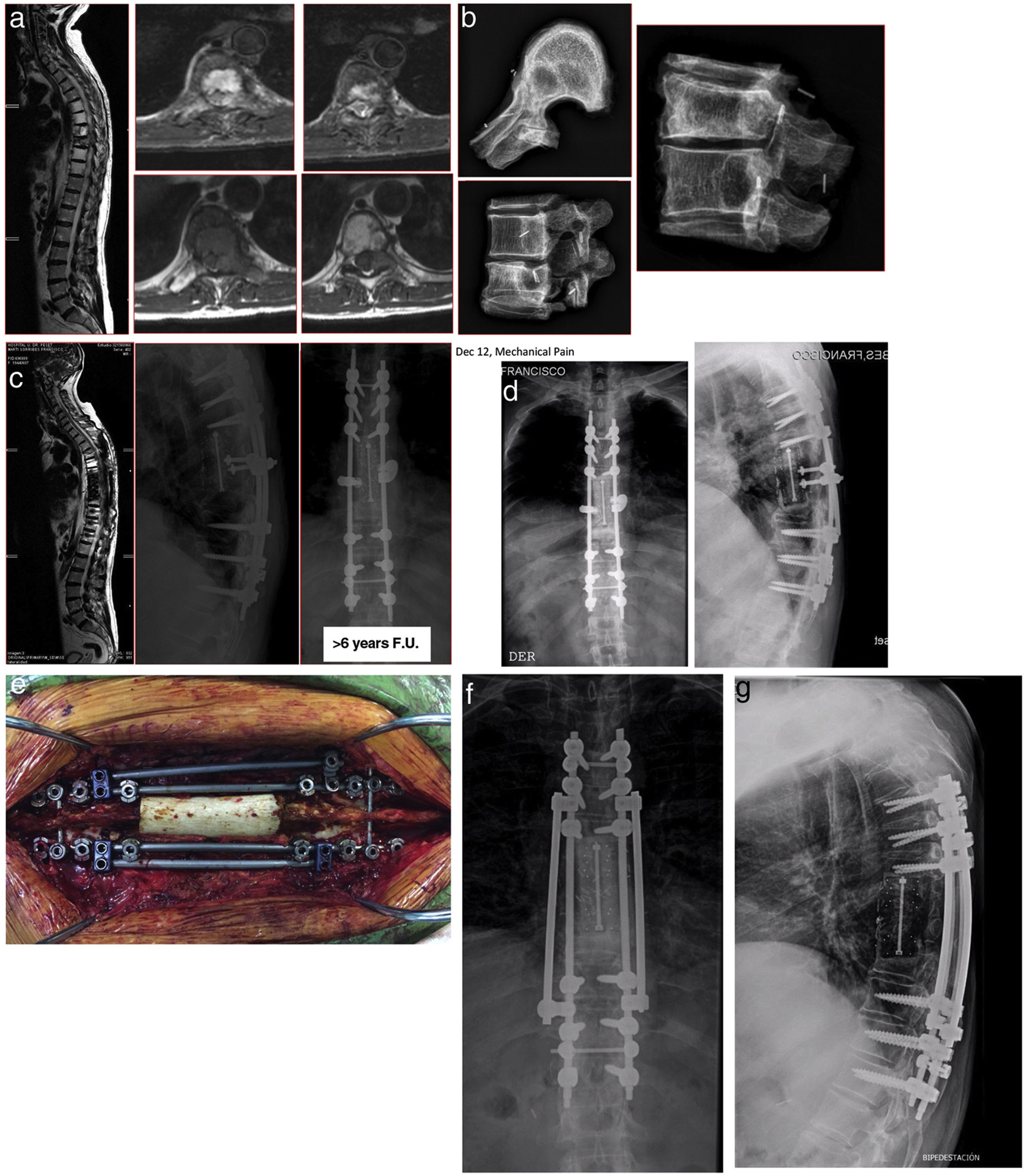 [Translated article] Vertebral metastases. En bloc treatment | Revista ...