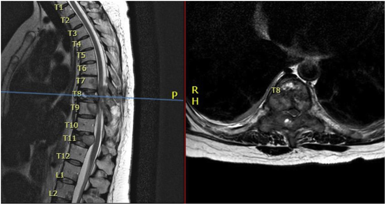 [Translated article] The role of minimally invasive spine surgery in ...