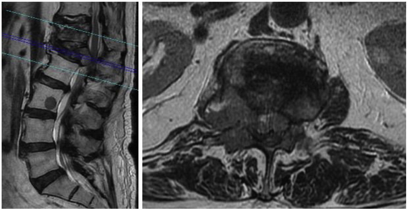 [Translated article] The role of minimally invasive spine surgery in ...