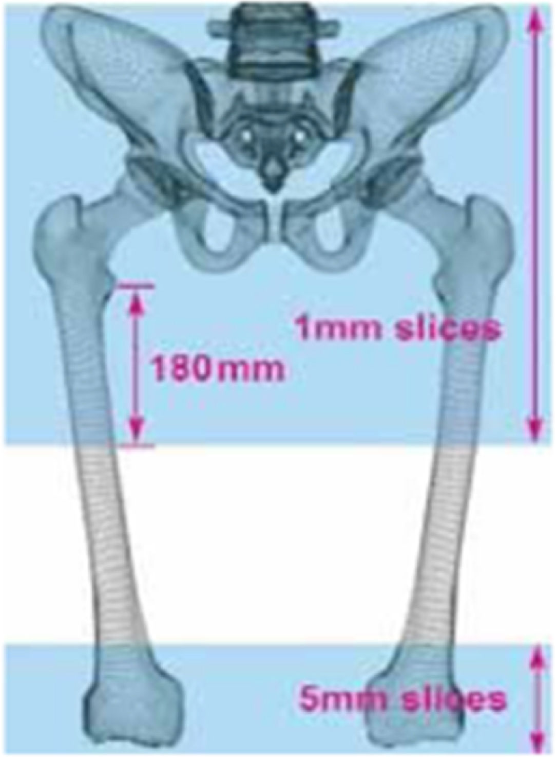 [Translated article] Clinical results of total hip arthroplasty ...