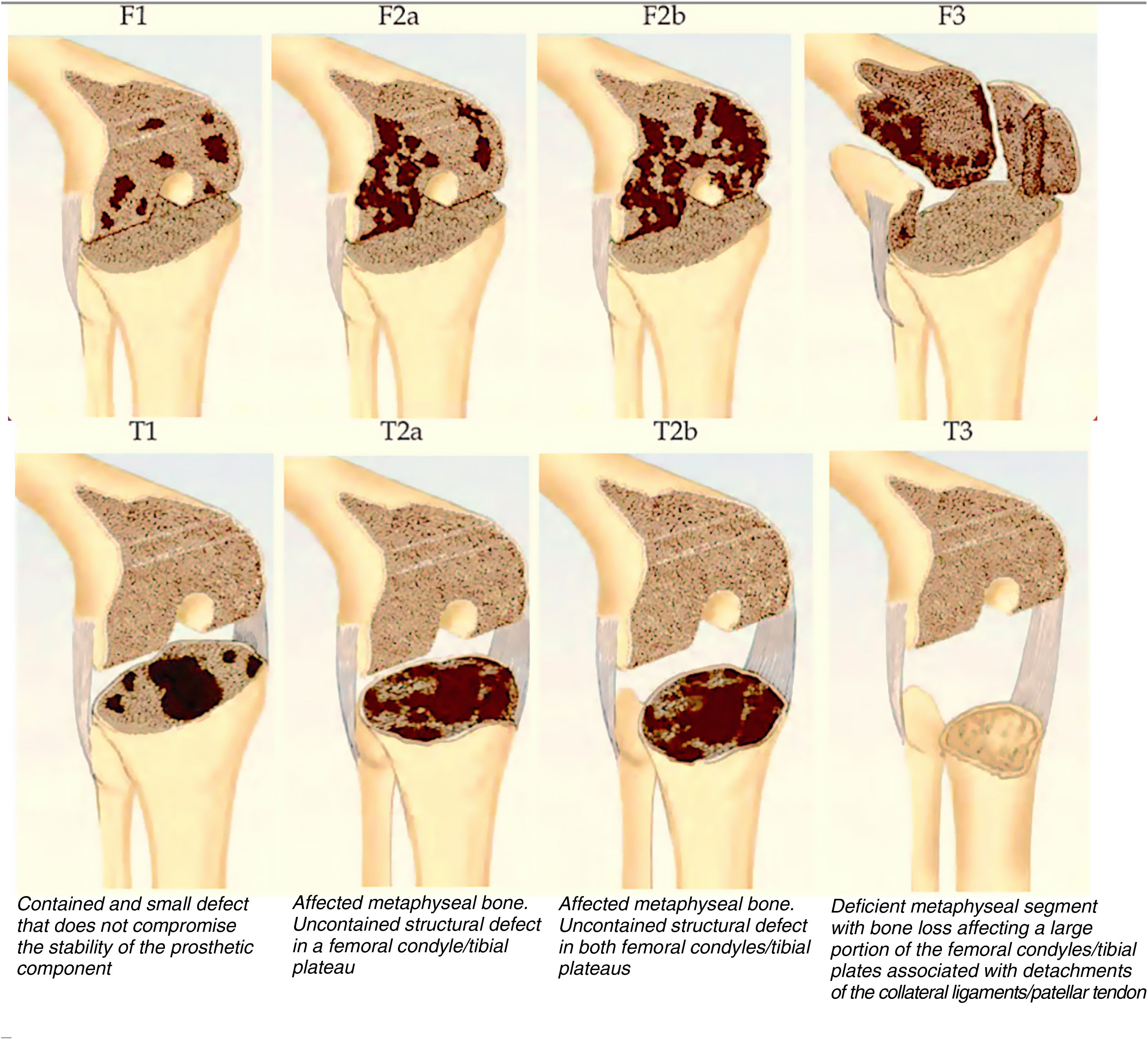 bone revision