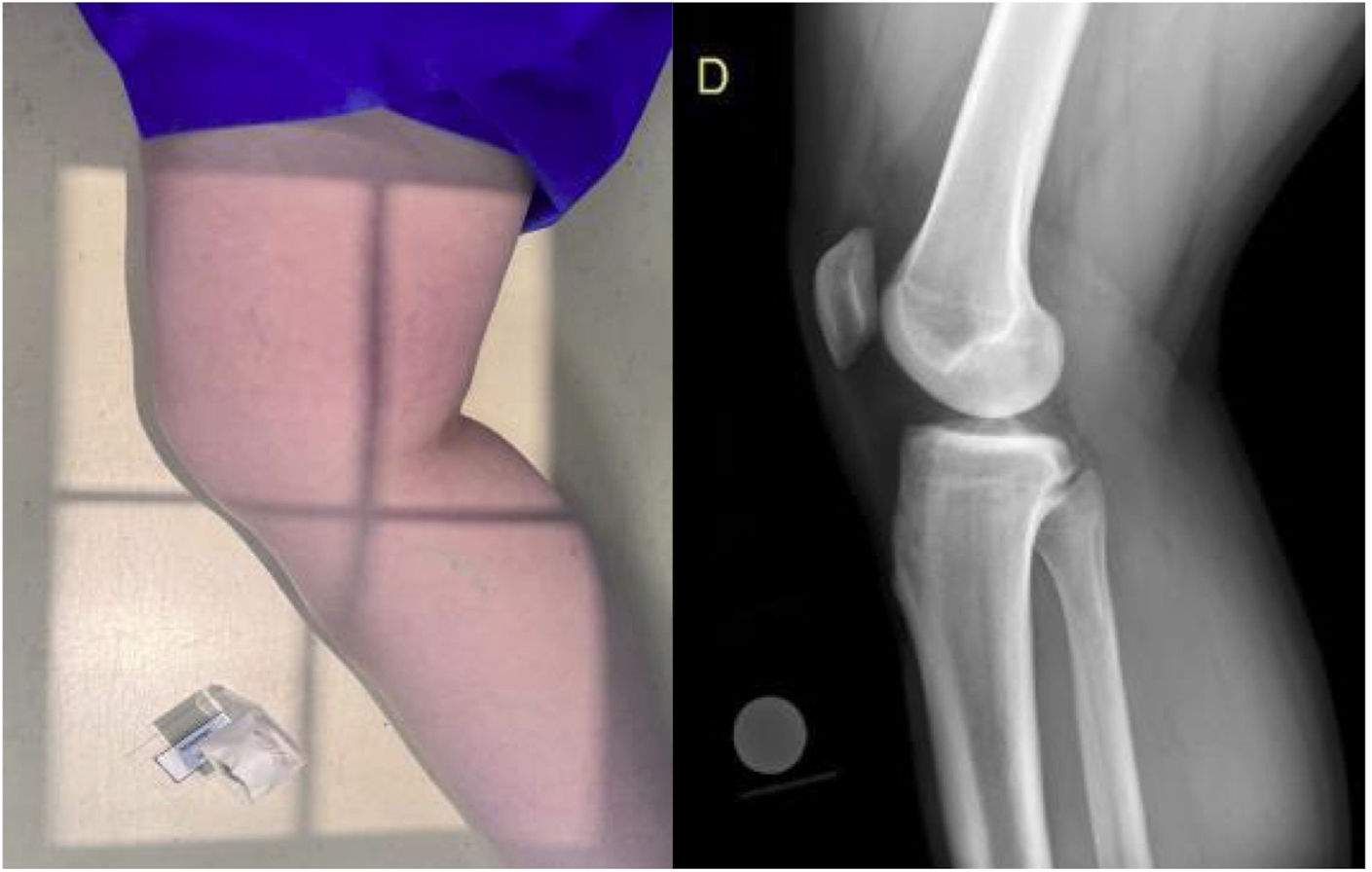 Isolated repair shows higher postoperative patellar height according to ...