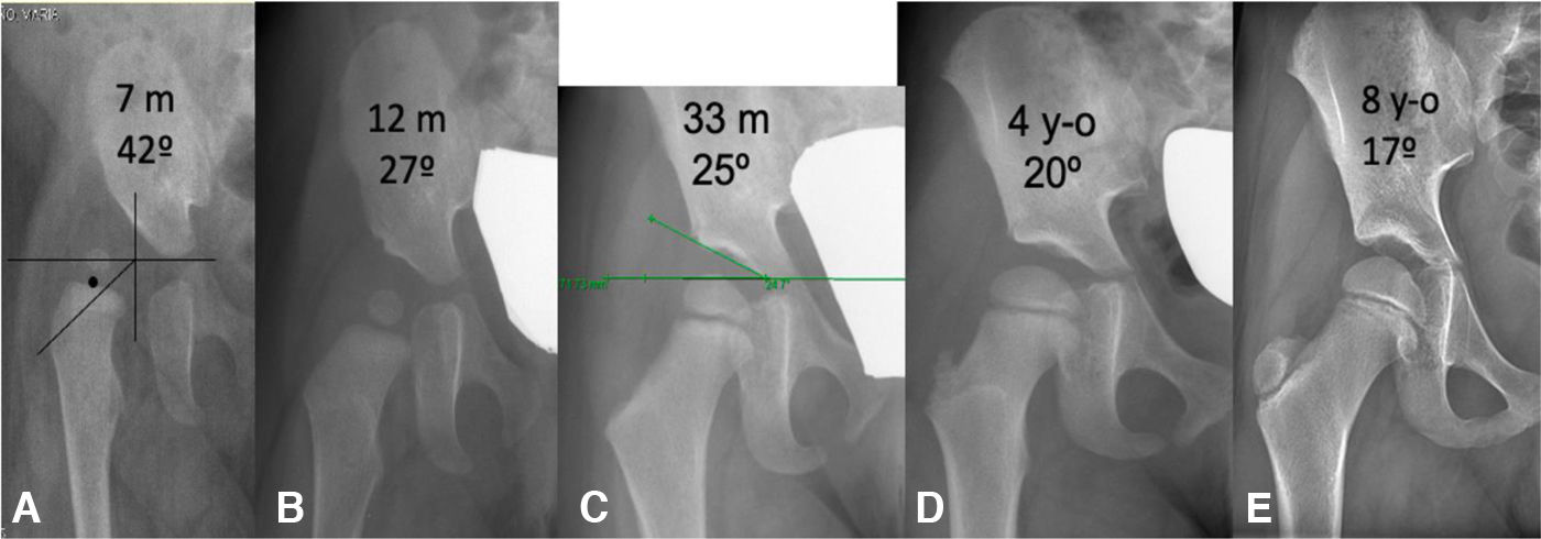 Early recovery of acetabular index in ddh as good prognosis factor ...