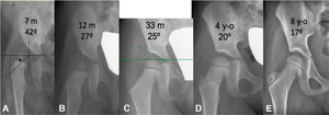 Early recovery of acetabular index in ddh as good prognosis factor ...