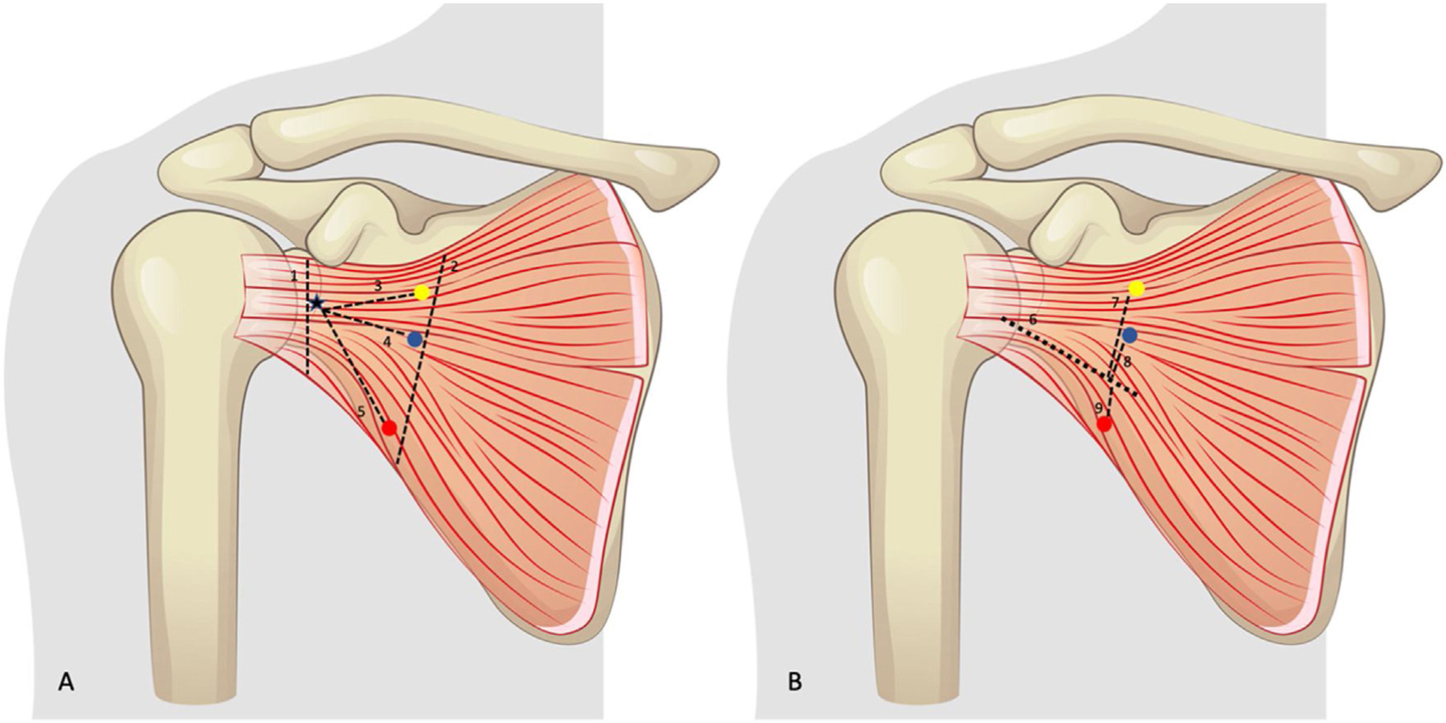[Translated article] Latarjet procedure for shoulder instability ...
