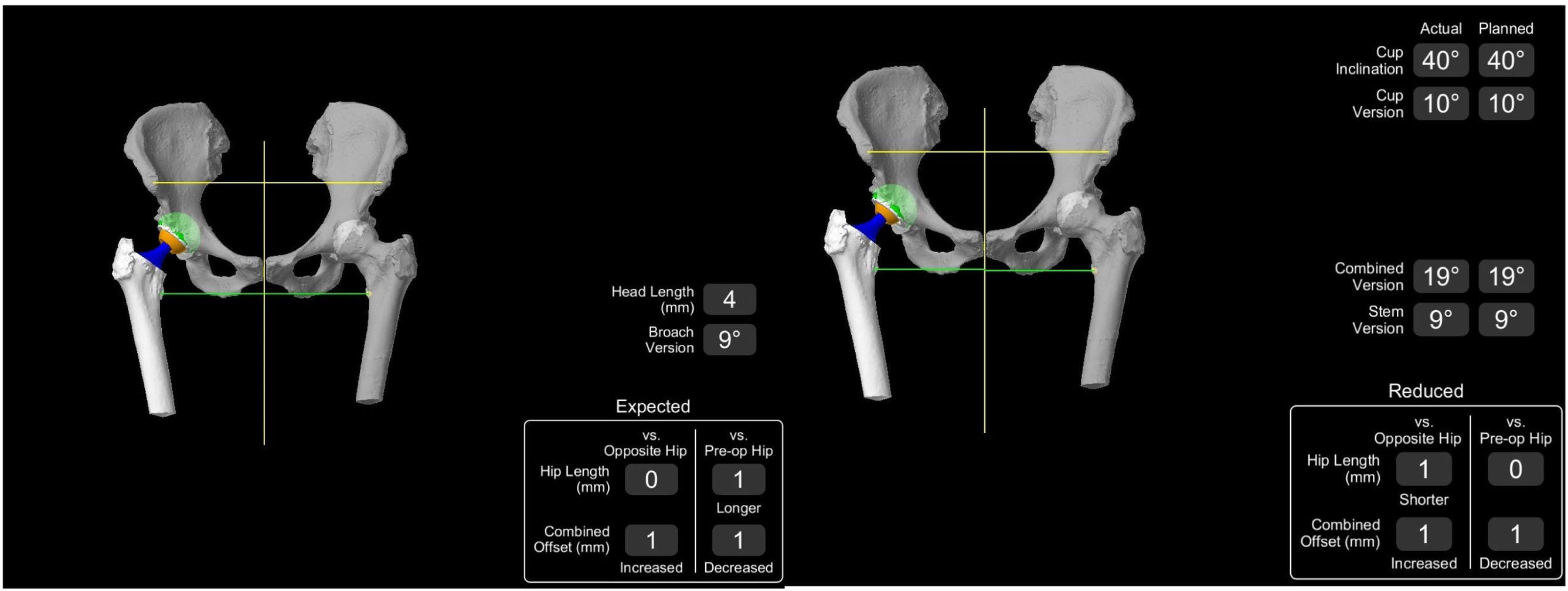 [Translated article] Clinical results of total hip arthroplasty ...