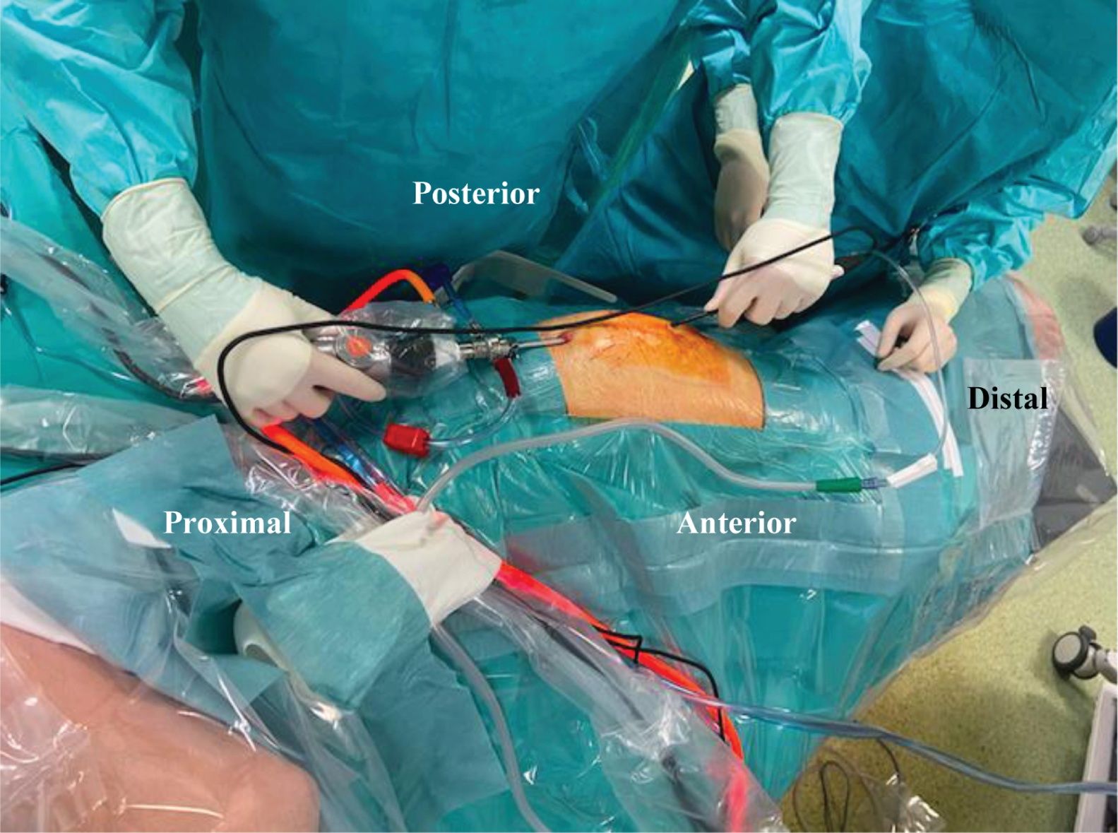 Preoperative instillation of epinephrine and lidocaine can reduce ...