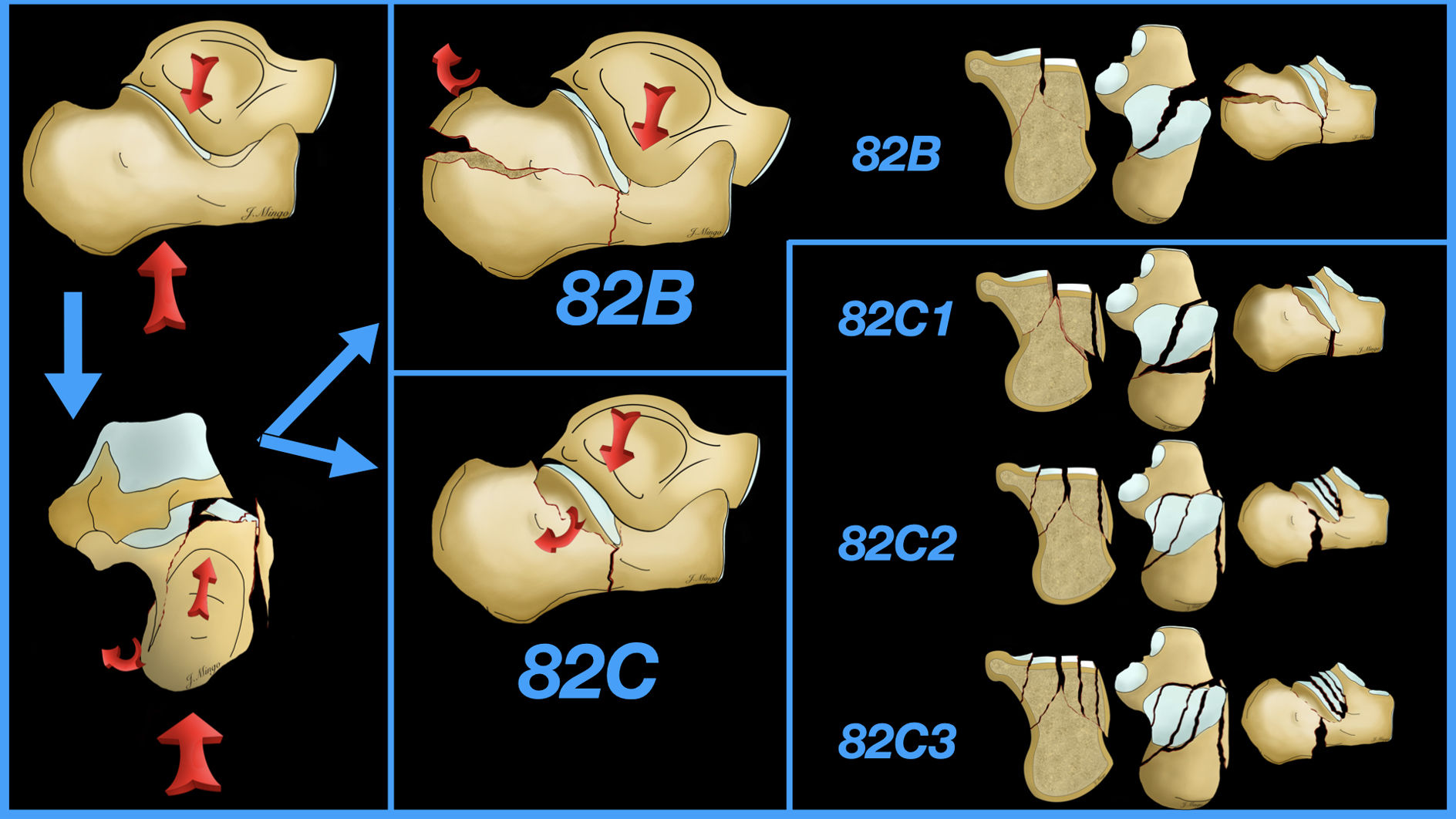 Treatment of displaced intra-articular calcaneal fractures using a ...
