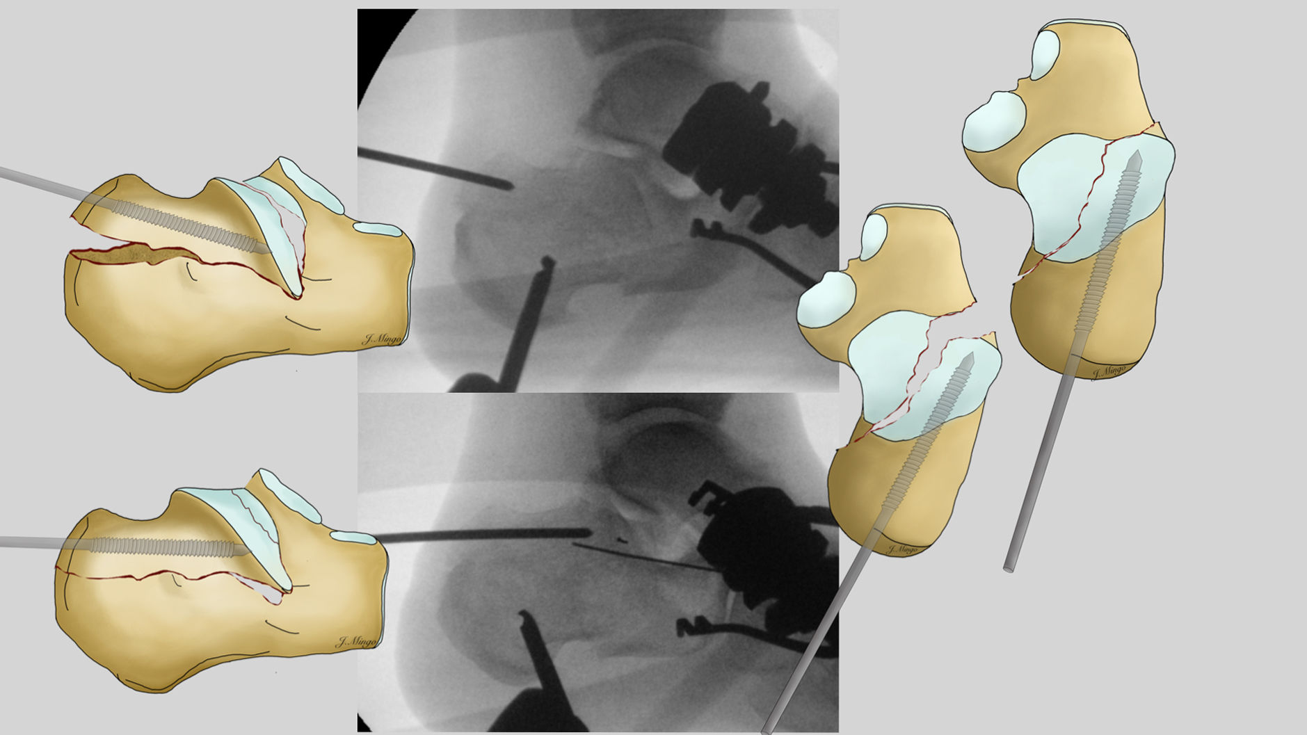 Treatment of displaced intra-articular calcaneal fractures using a ...