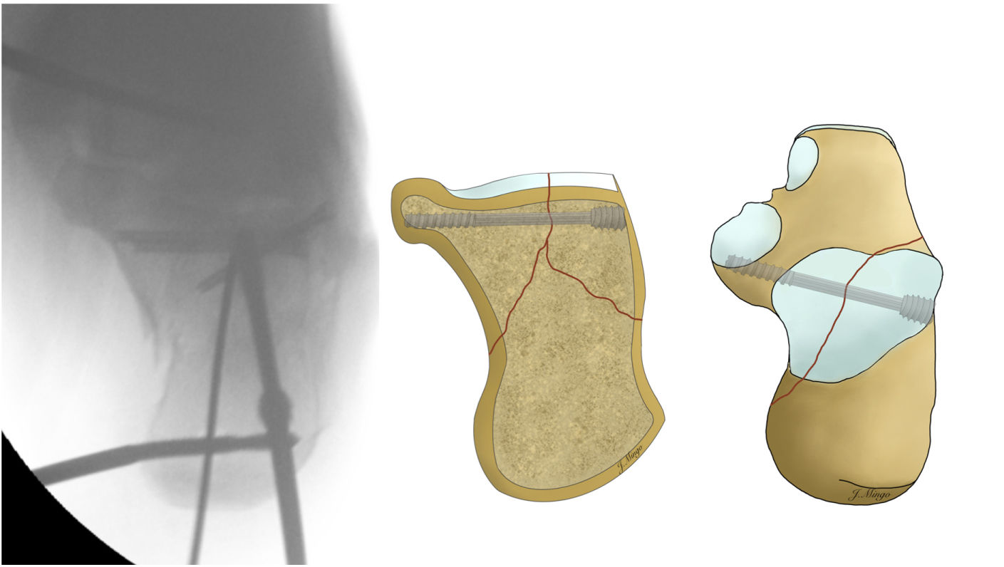 Treatment of displaced intra-articular calcaneal fractures using a ...