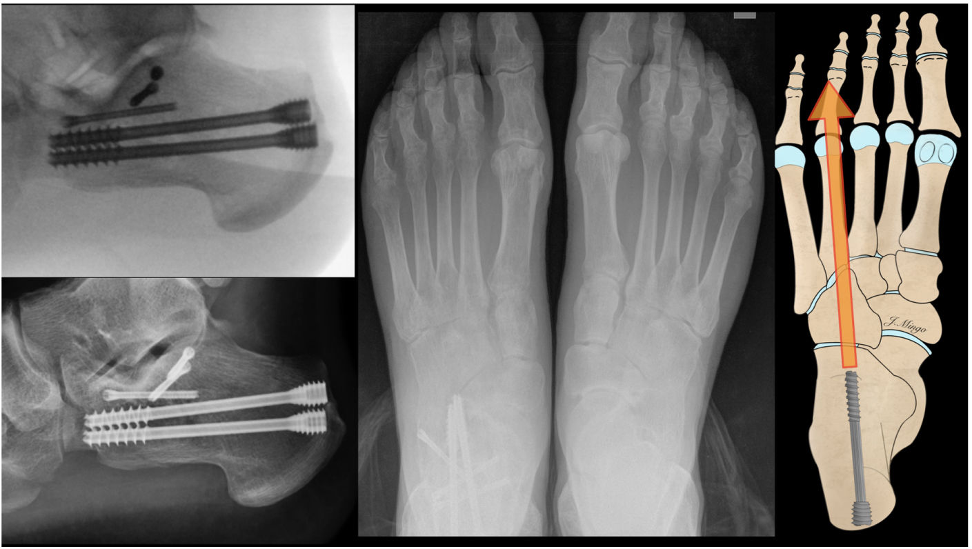 Treatment of displaced intra-articular calcaneal fractures using a ...