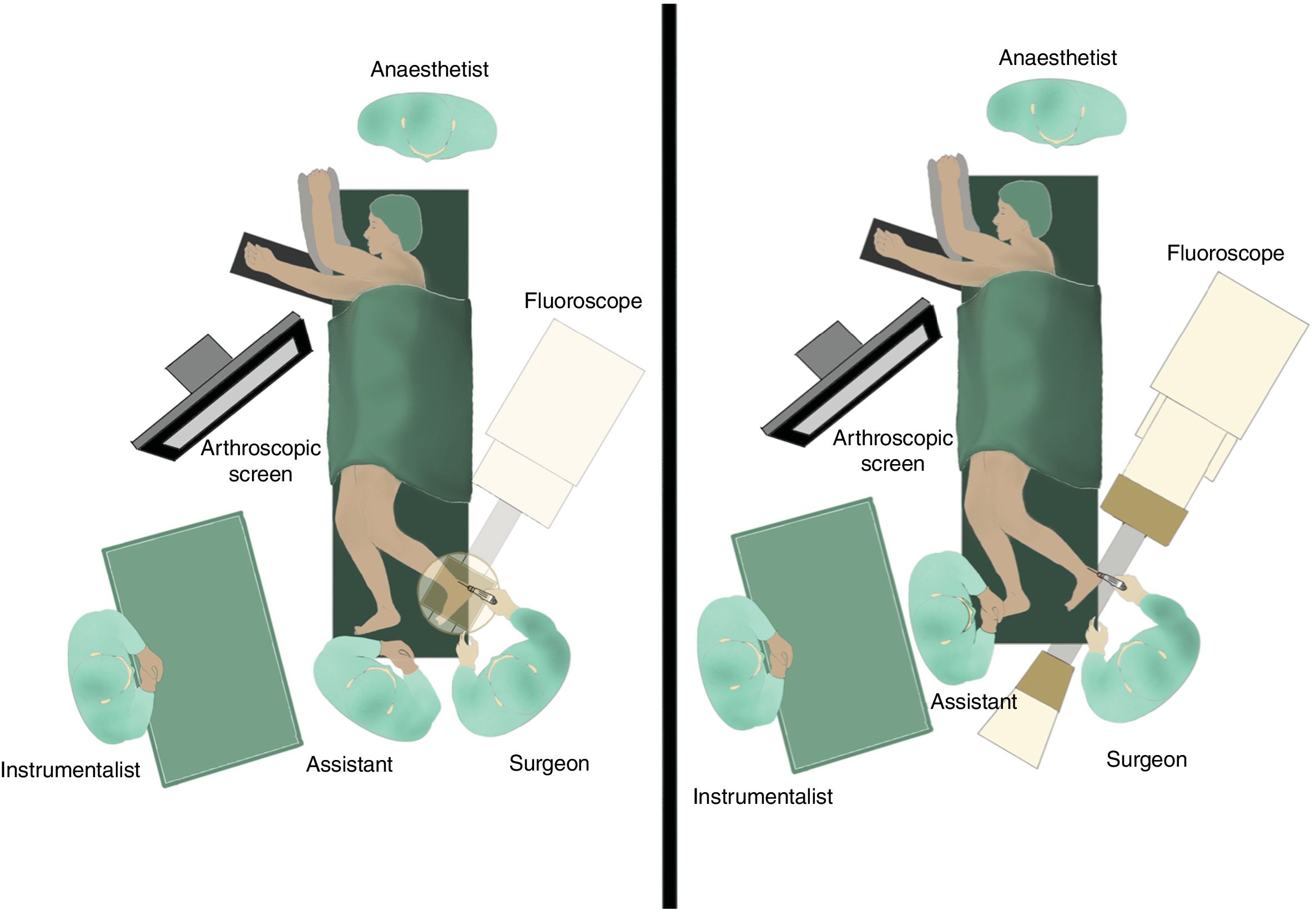 Treatment of displaced intra-articular calcaneal fractures using a ...