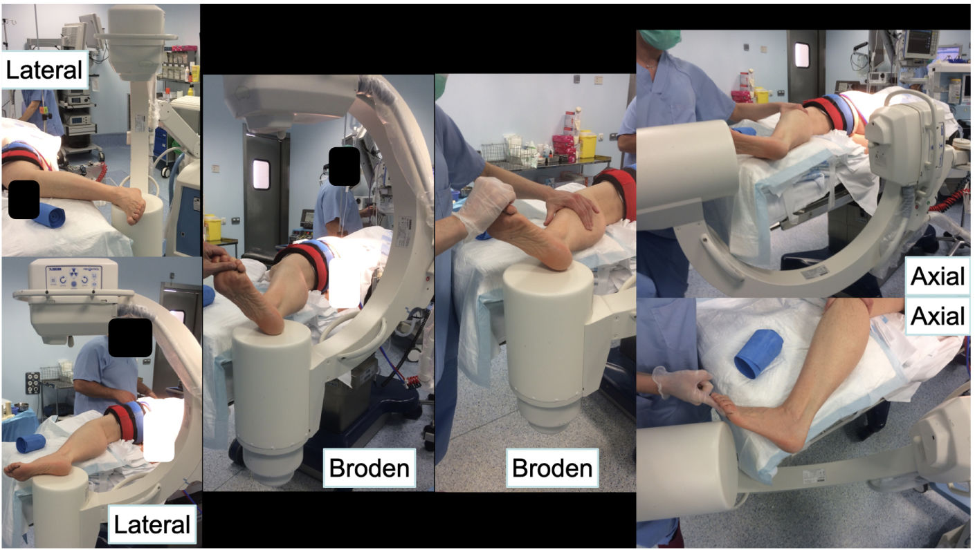 Treatment of displaced intra-articular calcaneal fractures using a ...