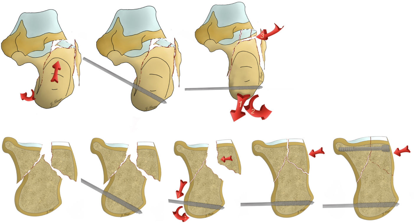 Treatment of displaced intra-articular calcaneal fractures using a ...