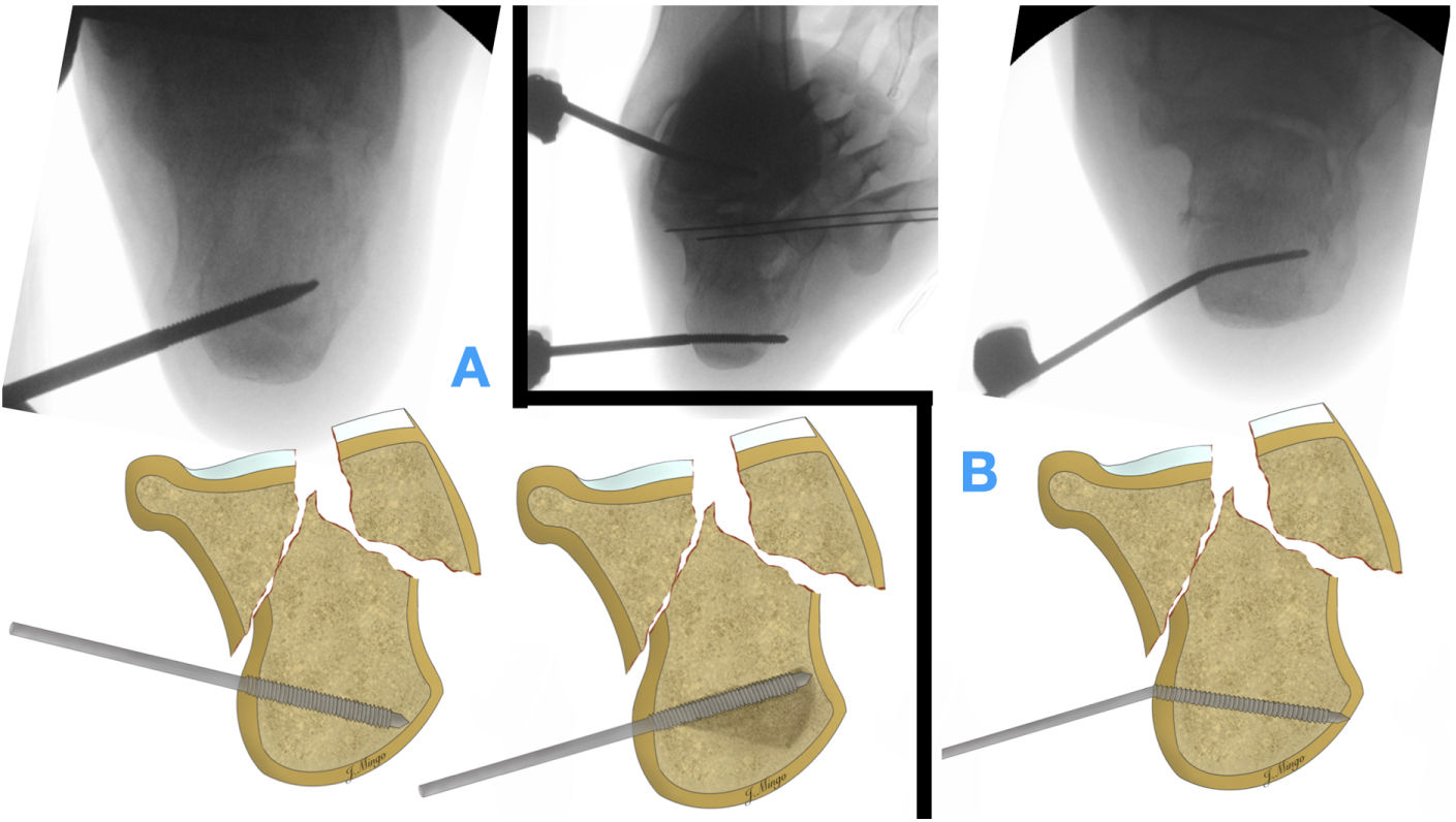 Treatment of displaced intra-articular calcaneal fractures using a ...