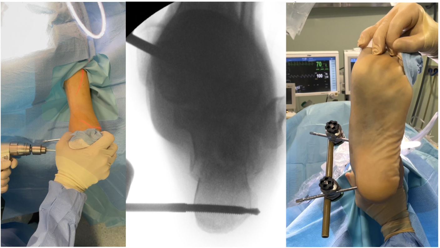 Treatment of displaced intra-articular calcaneal fractures using a ...