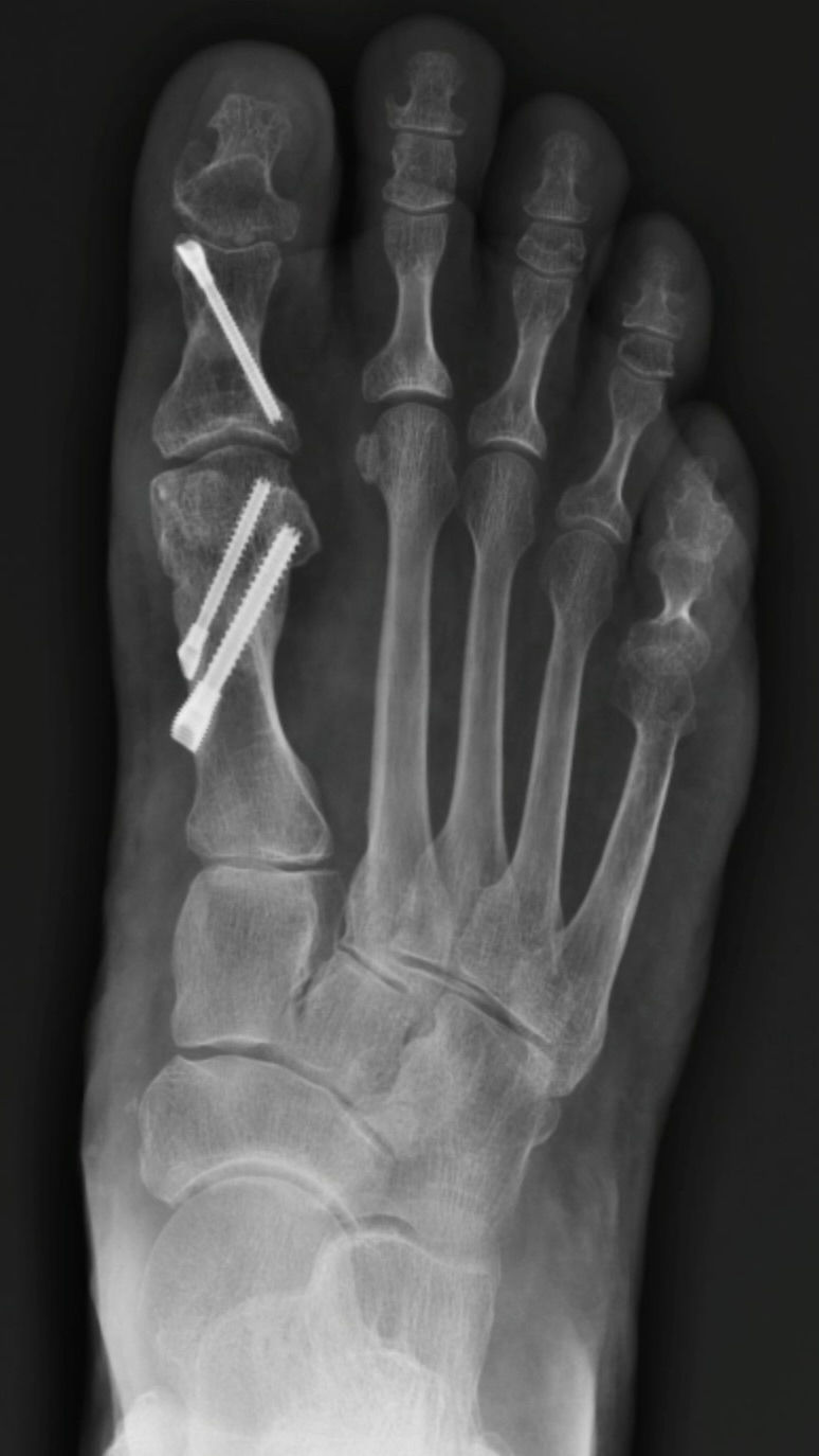 Evaluación a corto plazo de la osteotomía Chevron-Akin mínimamente ...