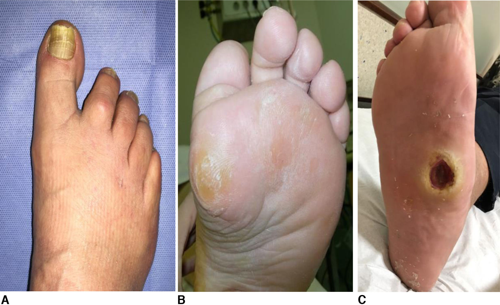Prevalence of diabetic foot in patients with diabetes mellitus ...