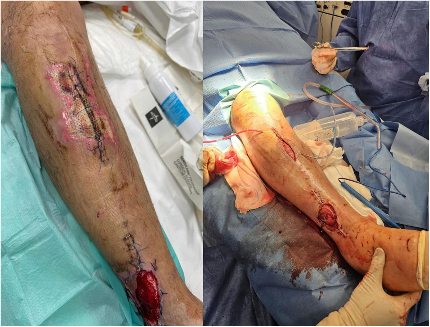 Musculoskeletal injuries treated following the flood in October 2024 in ...