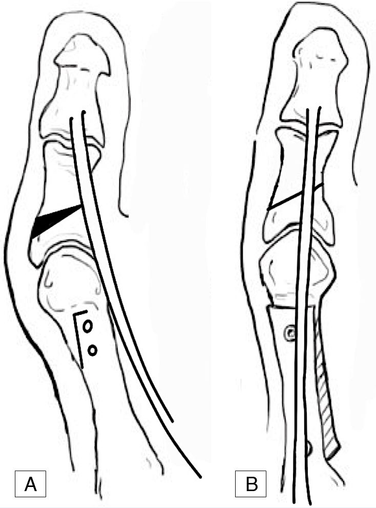 La fijación mediante sutura de partes blandas para la osteotomía de ...