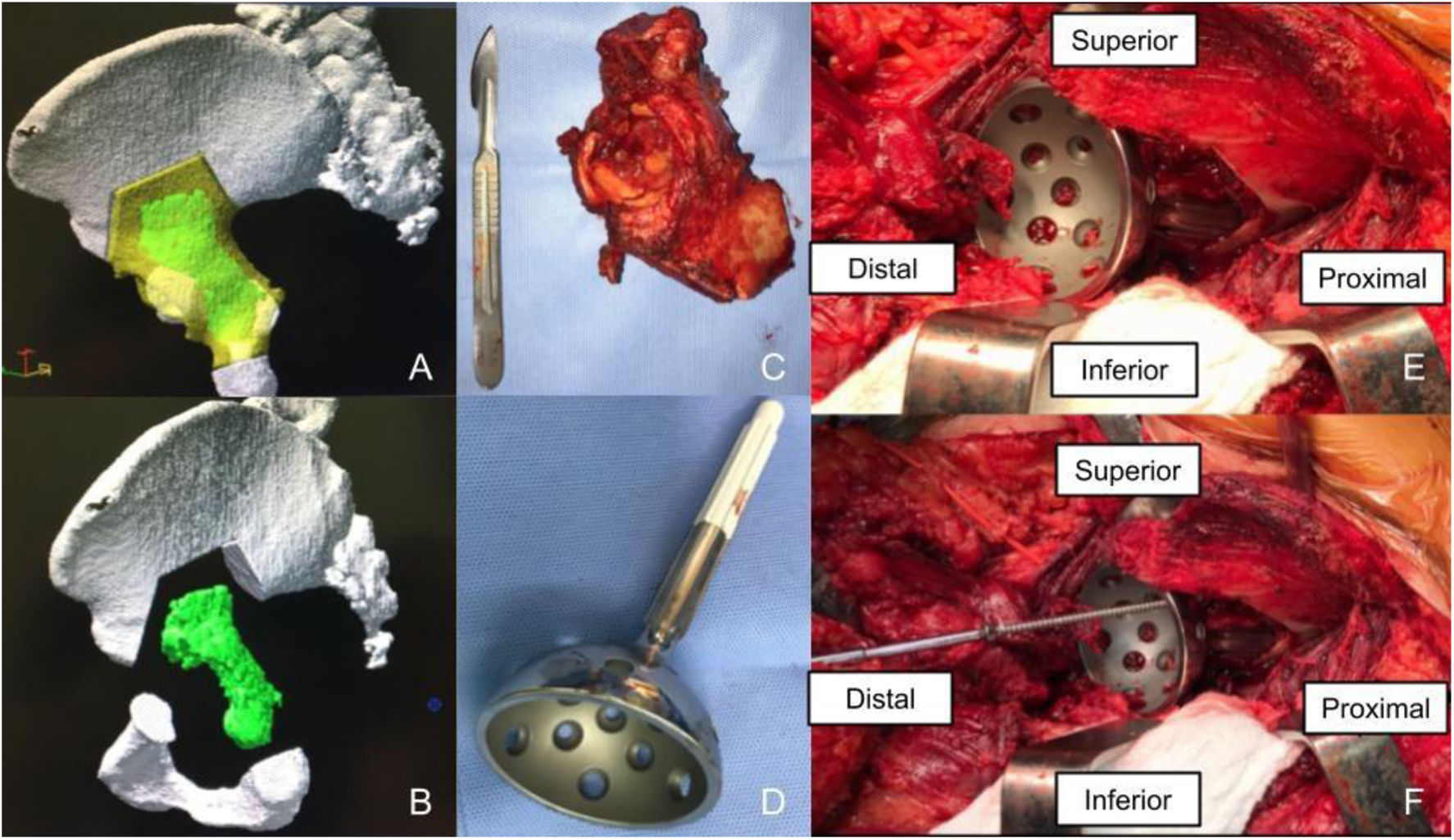 Use of “ice-cream cone” prosthesis in acetabular defects secondary to ...