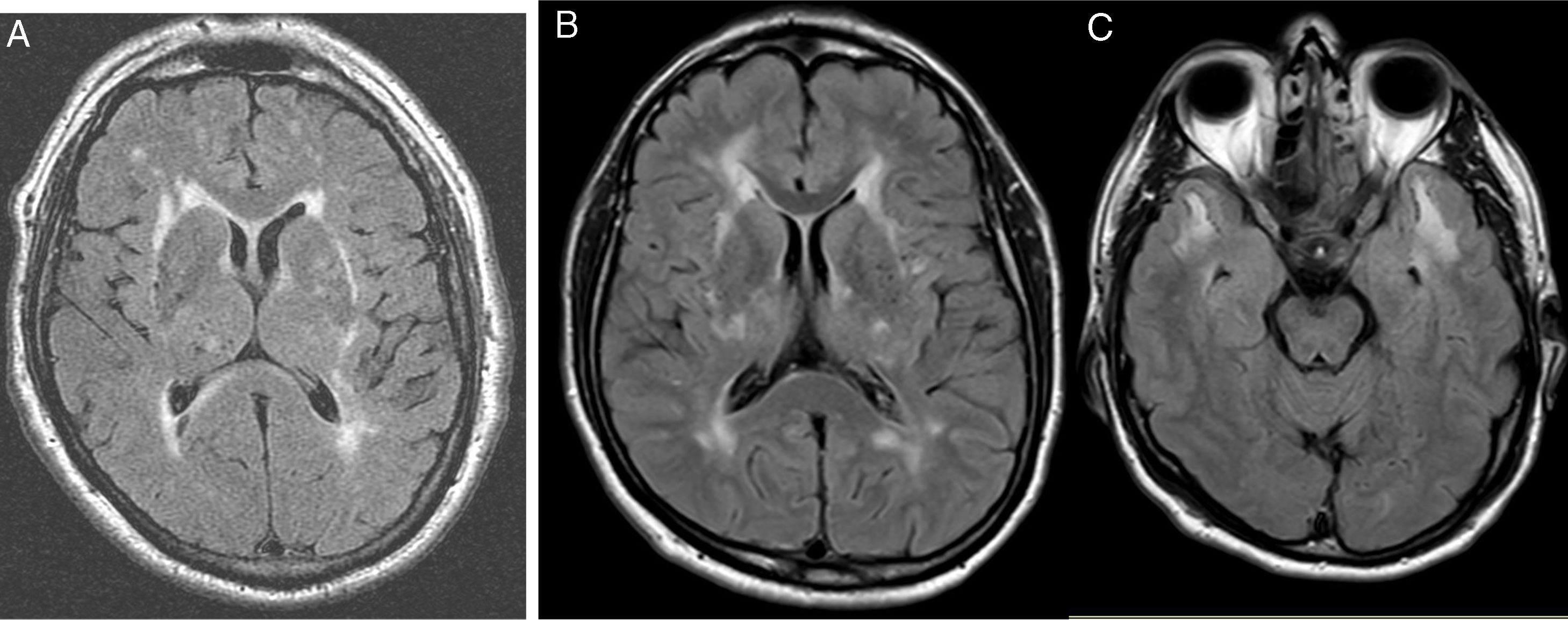 Enfermedad Cerebrovascular De Pequeño Vaso Hipertensión Y Riesgo Vascular