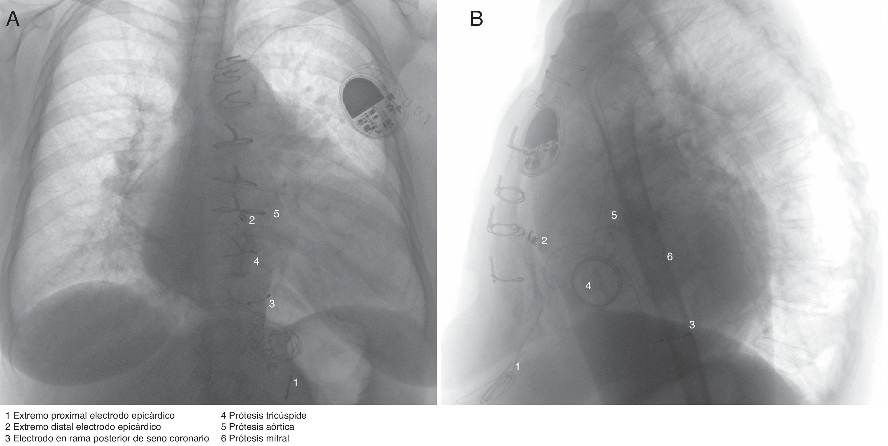 Estimulación ventricular permanente desde el seno coronario en paciente ...