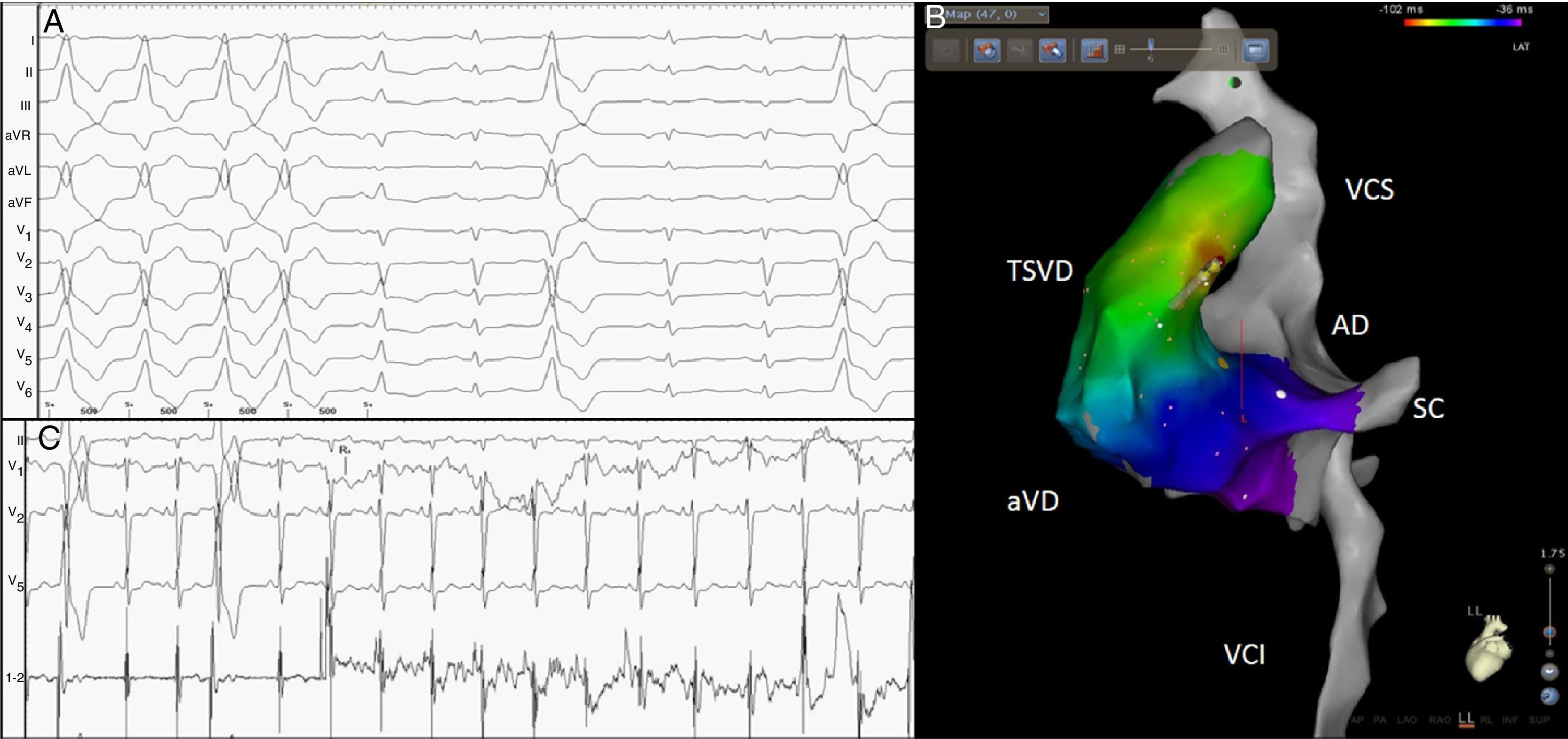 Extrasistolia ventricular: manejo diagnóstico y terapéutico | Cardiocore
