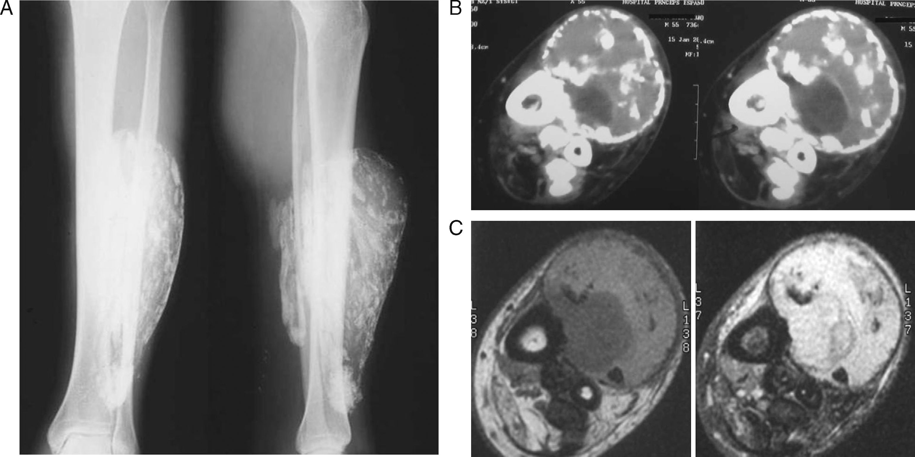 interosseous membrane calcification
