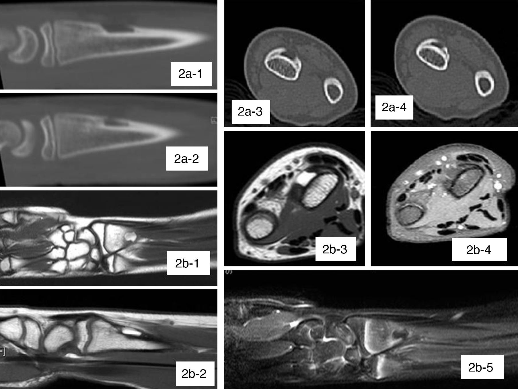 cortical bone defect mri