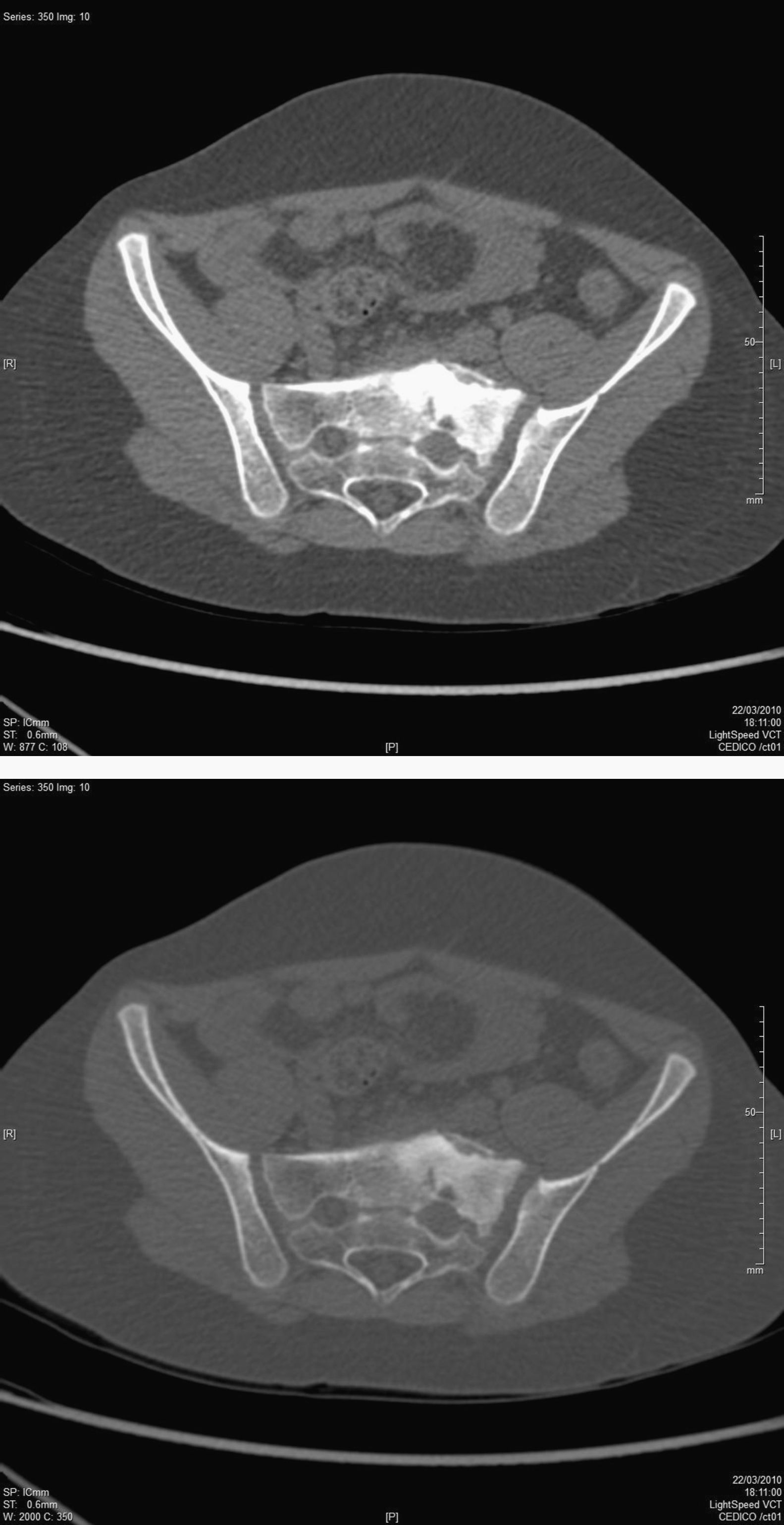 diffuse sclerosing osteomyelitis