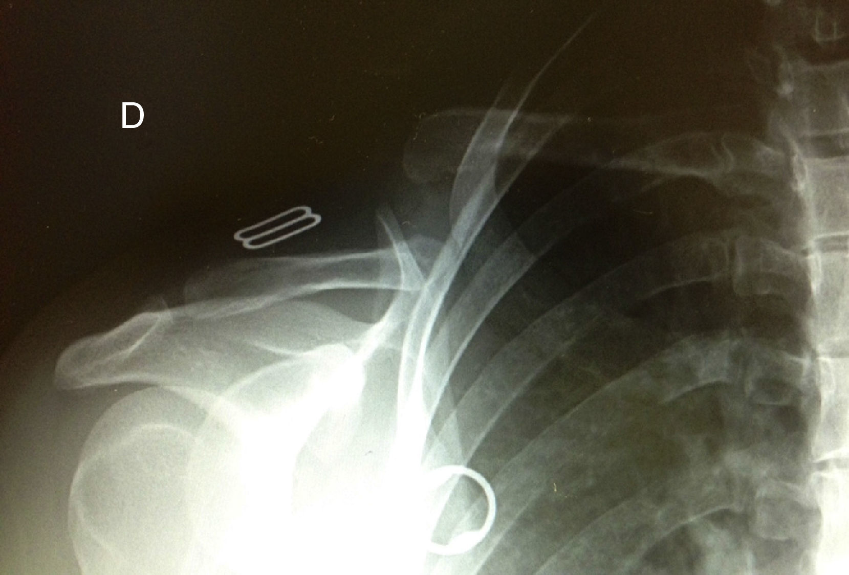 Functional and aesthetic results of orthopaedic treatment of midshaft ...