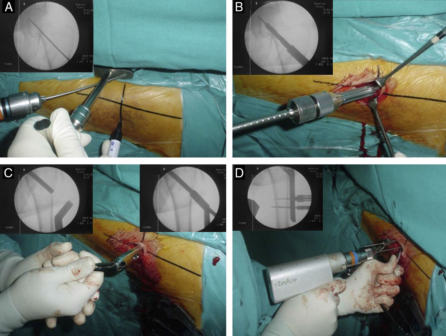 dynamic hip screw recovery in the elderly