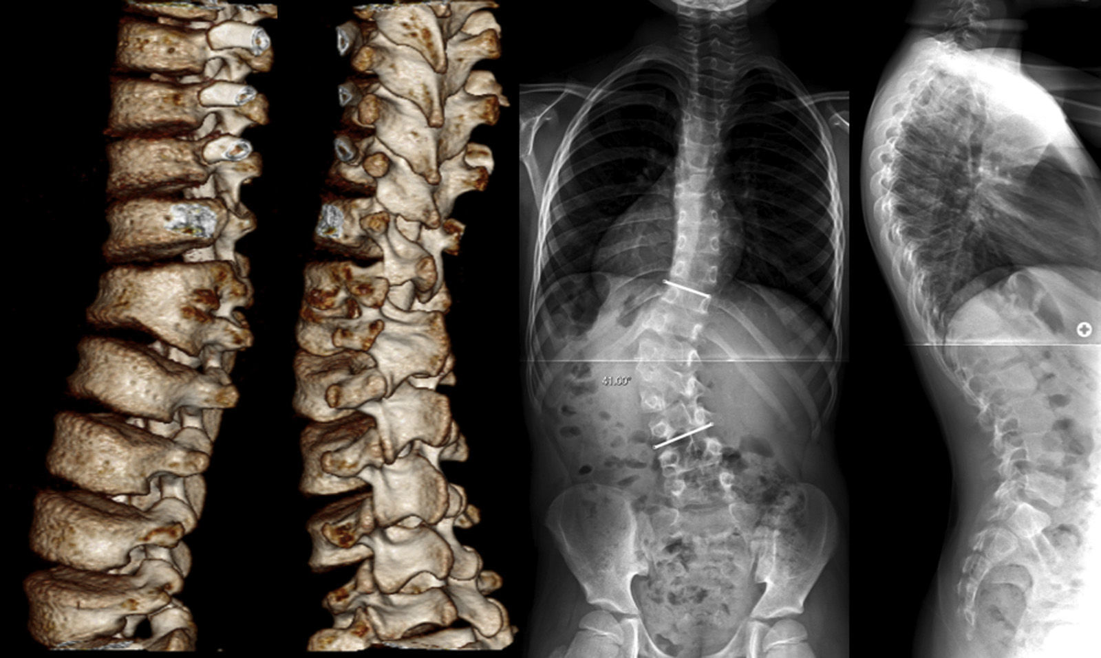 thoracic hemivertebra