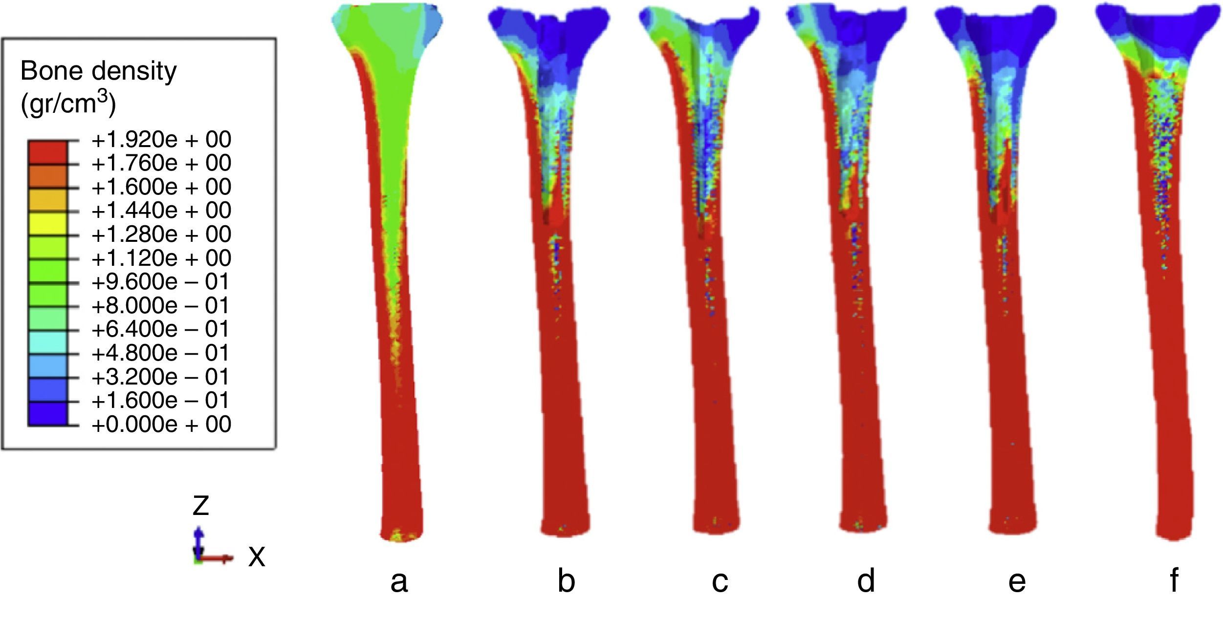 Biomechanical study of the tibia in knee replacement revision | Revista ...