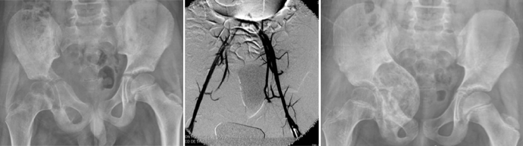 Background acetabular aneurysmal bone cyst in a 7 year-old ...