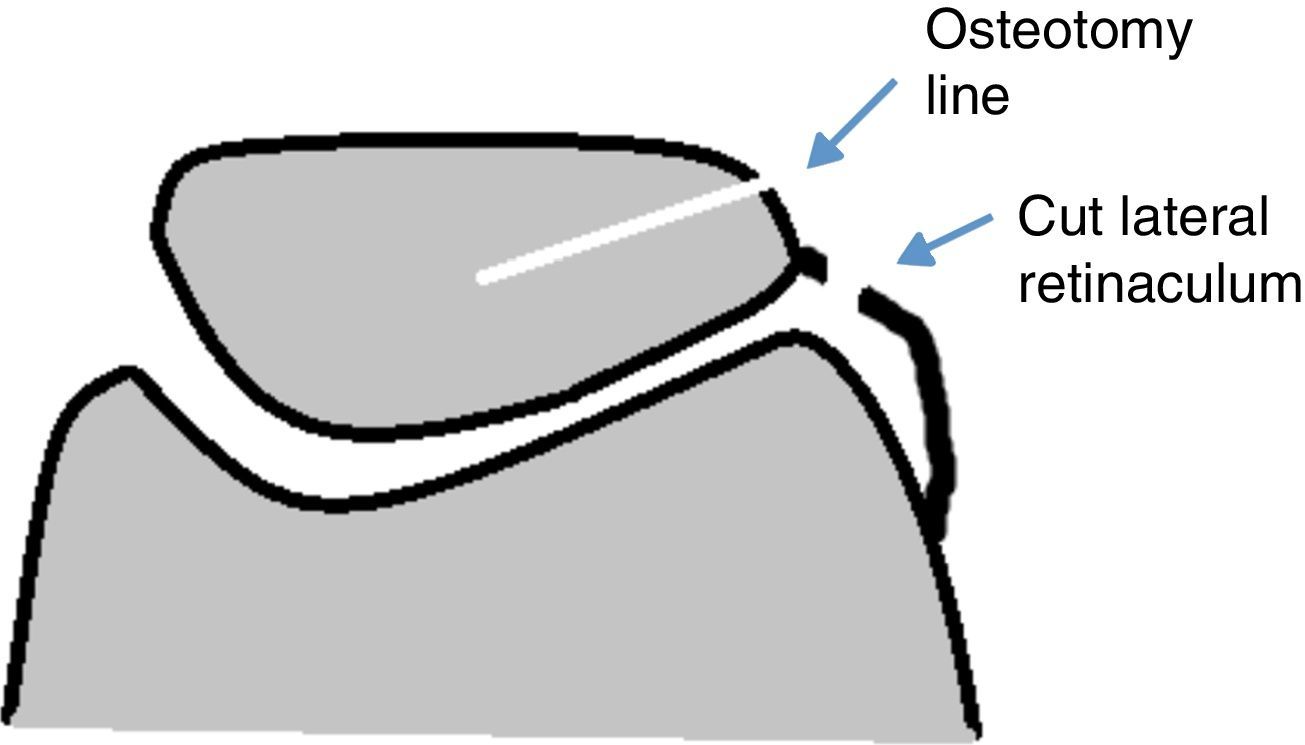 Coronal patellar osteotomy of the external facet combined with the ...