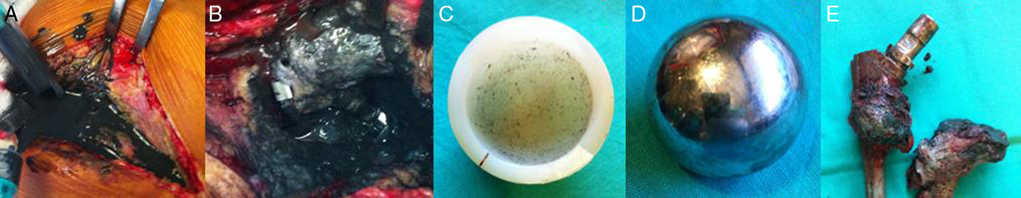 Cobalt toxicity after revision total hip replacement due to fracture of ...