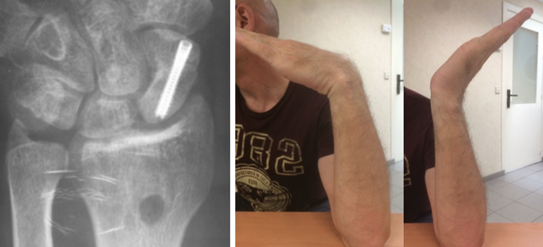 scaphoid bone operation