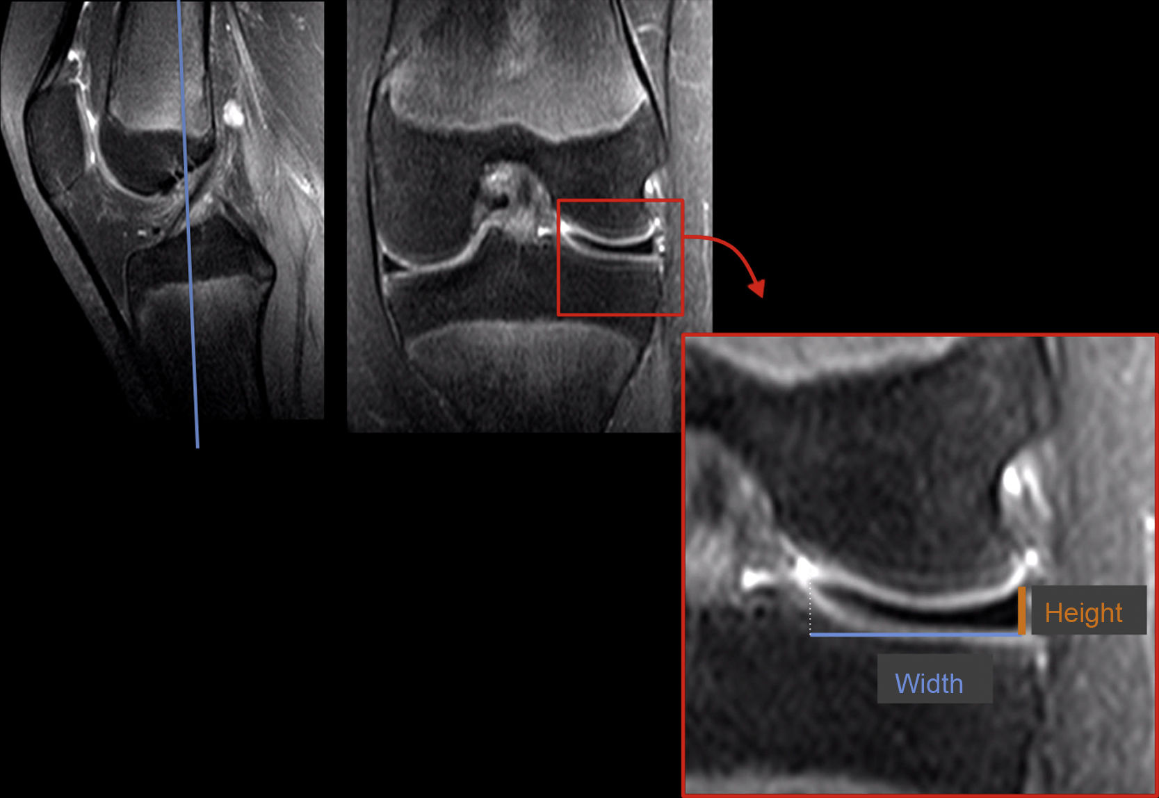 meniscus scan