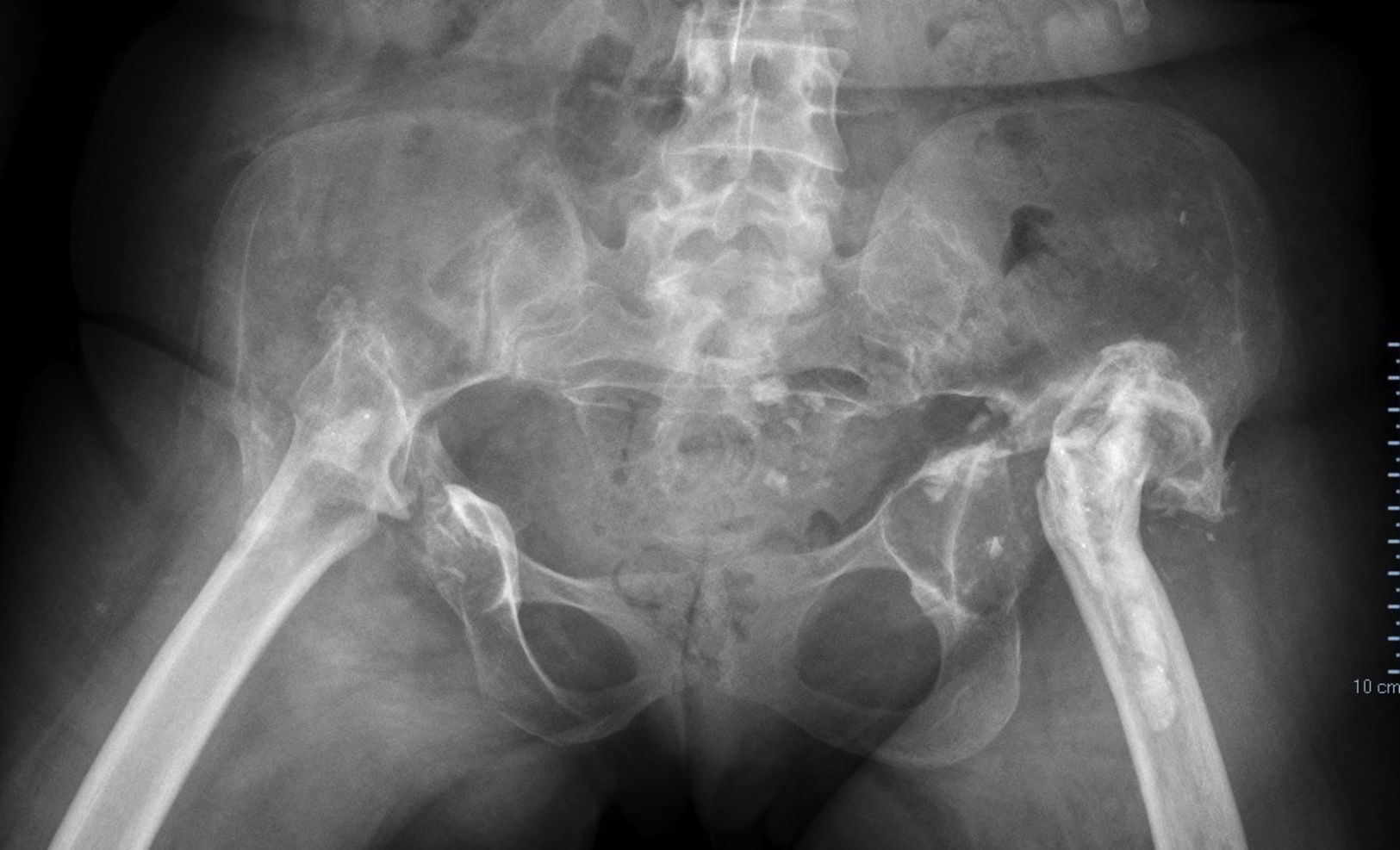 Quality of life after Girdlestone resection arthroplasty | Revista ...