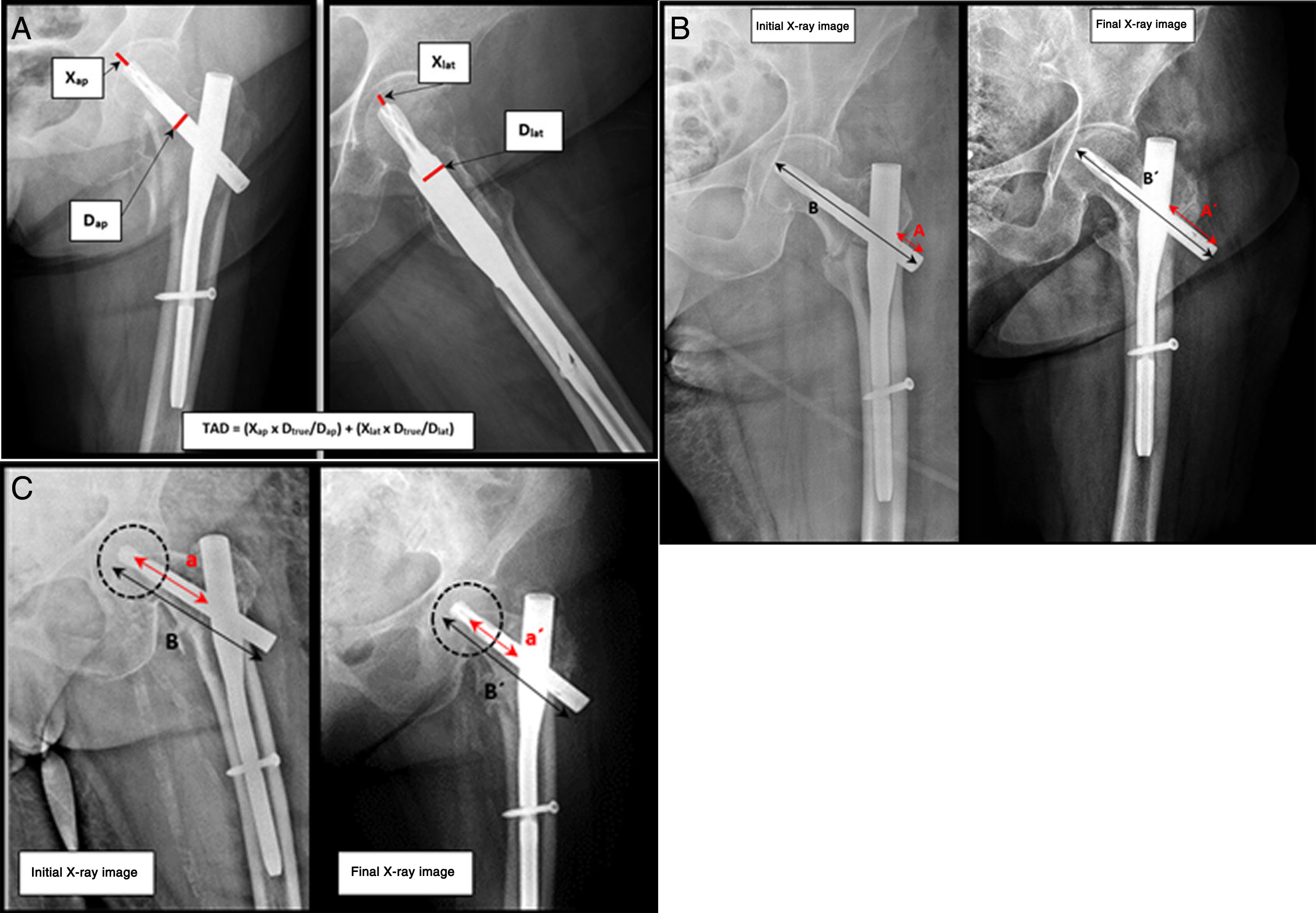 Does the fracture of the lateral wall affect the degree of collapse and ...