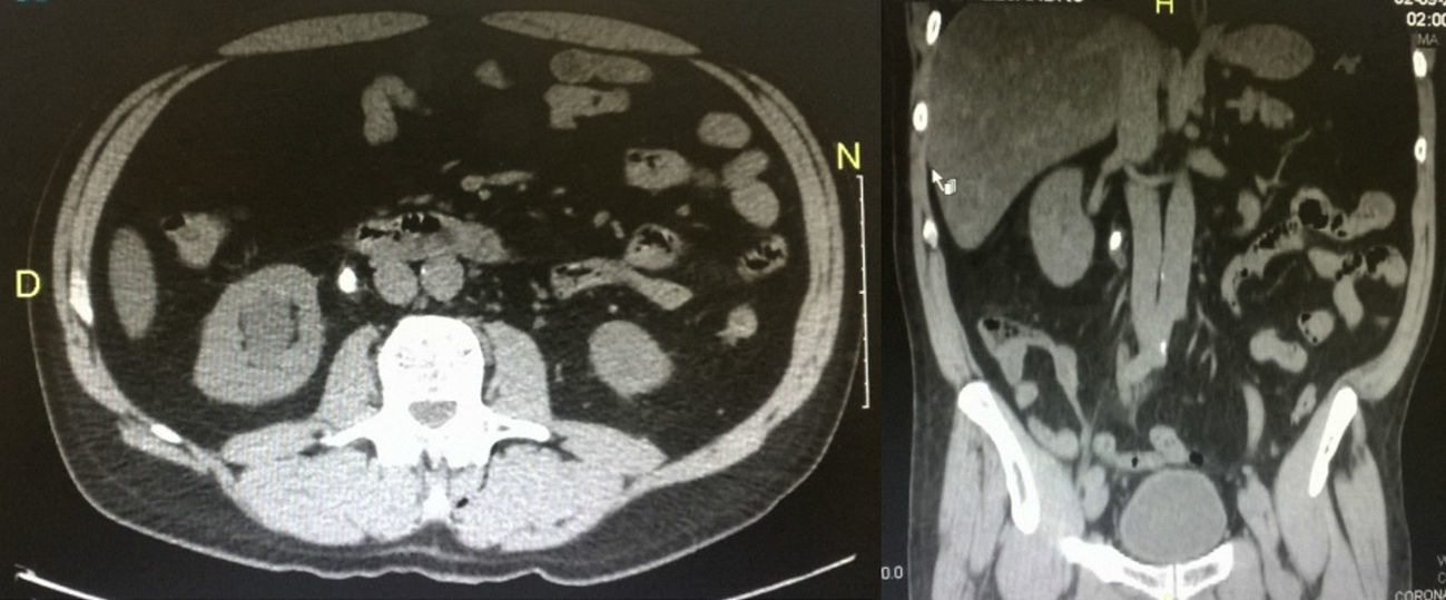 Carcinoma de células transicionales asociado con litiasis de la unión ...