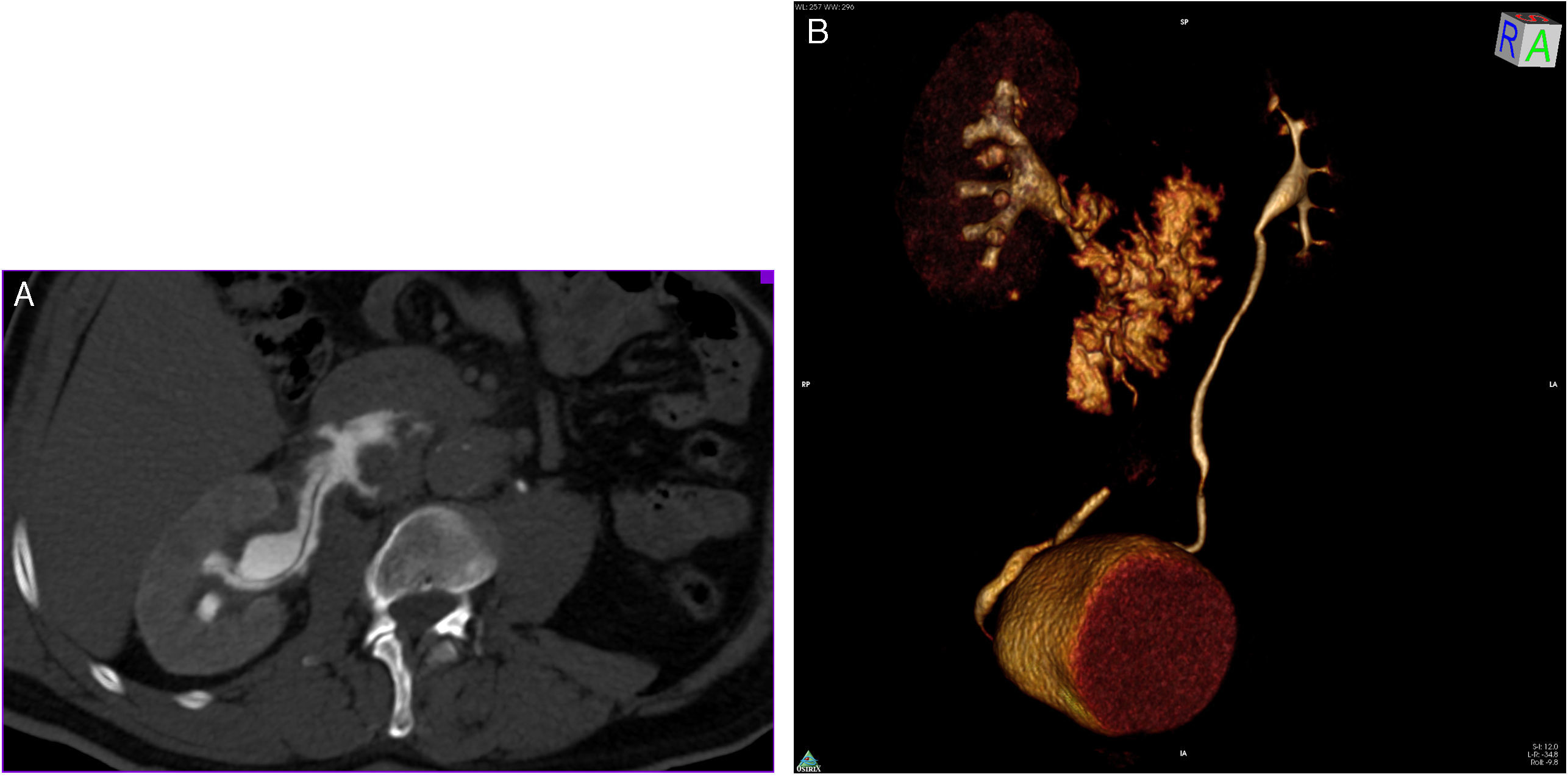 Rotura forniceal y urinoma secundario a fibrosis retroperitoneal: caso ...