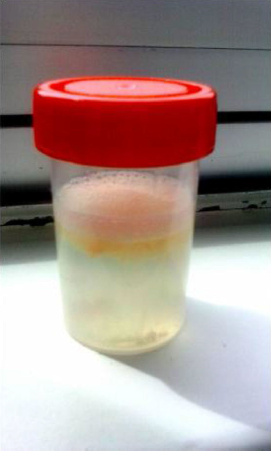 Orange sputum in a kidney transplant patient with Legionella micdadei ...